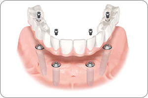 Dental Implants | Adelaide MaxFax